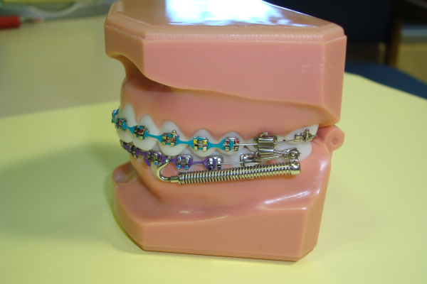 Orthodontic Appliances in Vallejo, Moraga & Pinole, CA | Axelrode ...